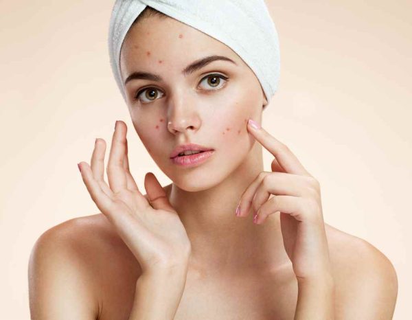 Ultimate Guide to Essential Oils for Acne